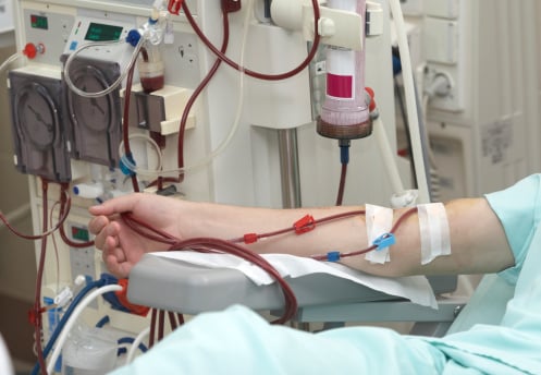 Congestive Heart Failure in Hemodialysis Patients with Excellent Fistulas