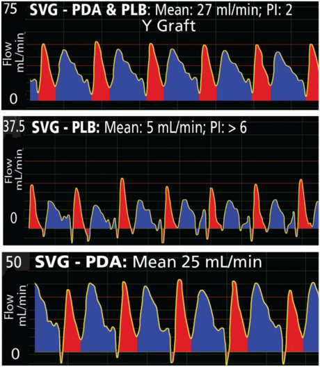 3 Interesting CABG Cases You Will Be Glad You Read